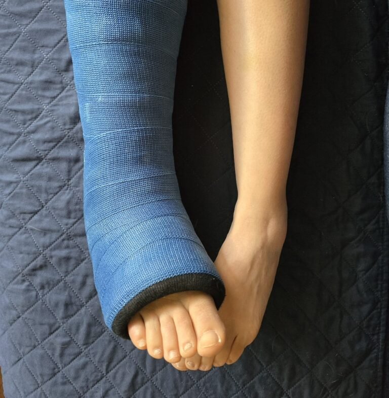 The Ultimate Guide to Comfort and Mobility in a Cast - Fractured to Fitness